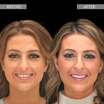 How Do Veneers Work? Process & Benefits Explained