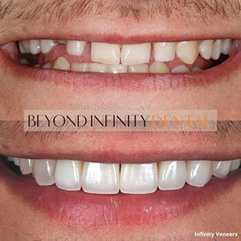 Improve Teeth Appearance – How Dental Veneers Treatment Can Help?