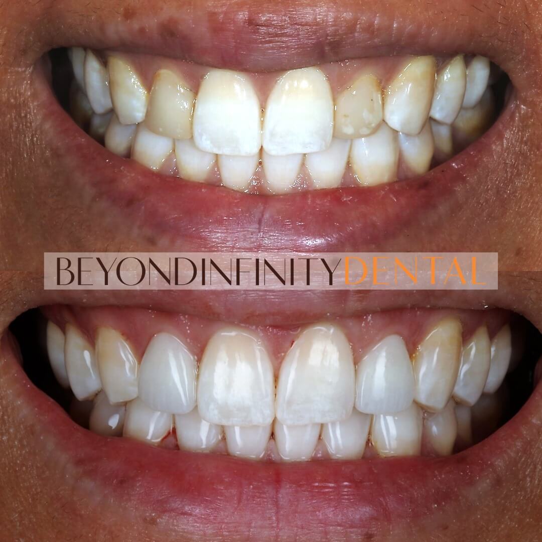 How to Fill A Gap In Your Teeth And Why You Should | Beyond Infinity Dental