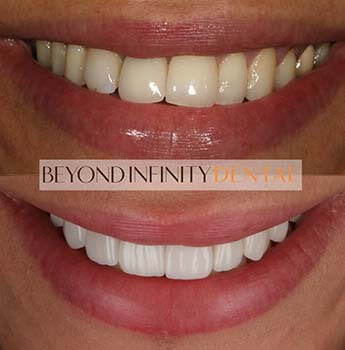 How Veneers Work? Check Out the Looks, Cost, and Emotional Wellbeing