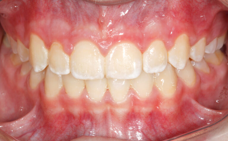 Jutting Teeth Re-adjusted with Braces - Beyond Infinity Dental