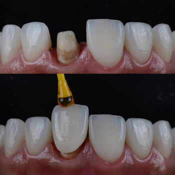 Do Veneers Damage Teeth? | Beyond Infinity Dental