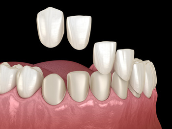 Do Veneers Damage Teeth? | Beyond Infinity Dental