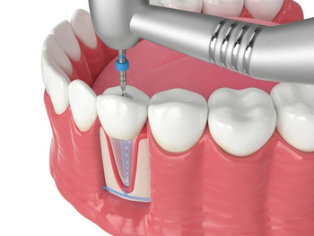 How Long Does a Root Canal Take? Your Complete Process Guide
