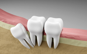 Impacted Wisdom Tooth: Symptoms, Causes, and Solutions