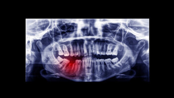 Understanding Root Canal Recovery Time for a Smooth Healing